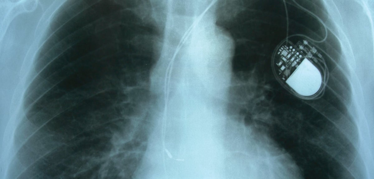 Pacemakers and Defibrillators | Saint Agnes Medical Center